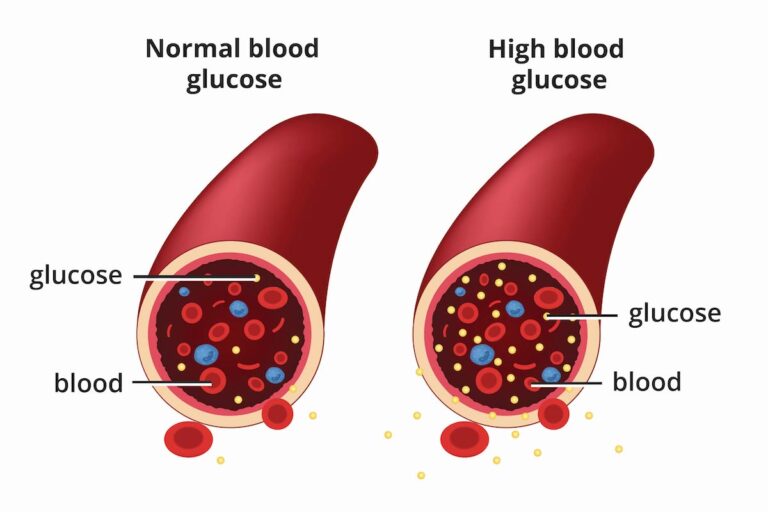 What Is Diabetes? Symptoms, Causes, and Treatment