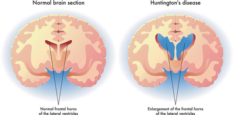 The Science Behind Huntington’s Disease