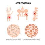 What Is Osteoporosis? How Bones Become Fragile