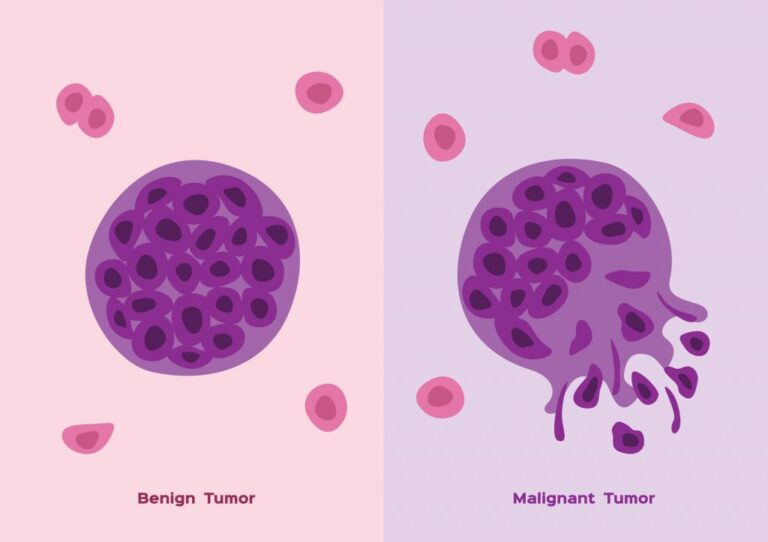 The Difference Between Benign and Malignant Tumors