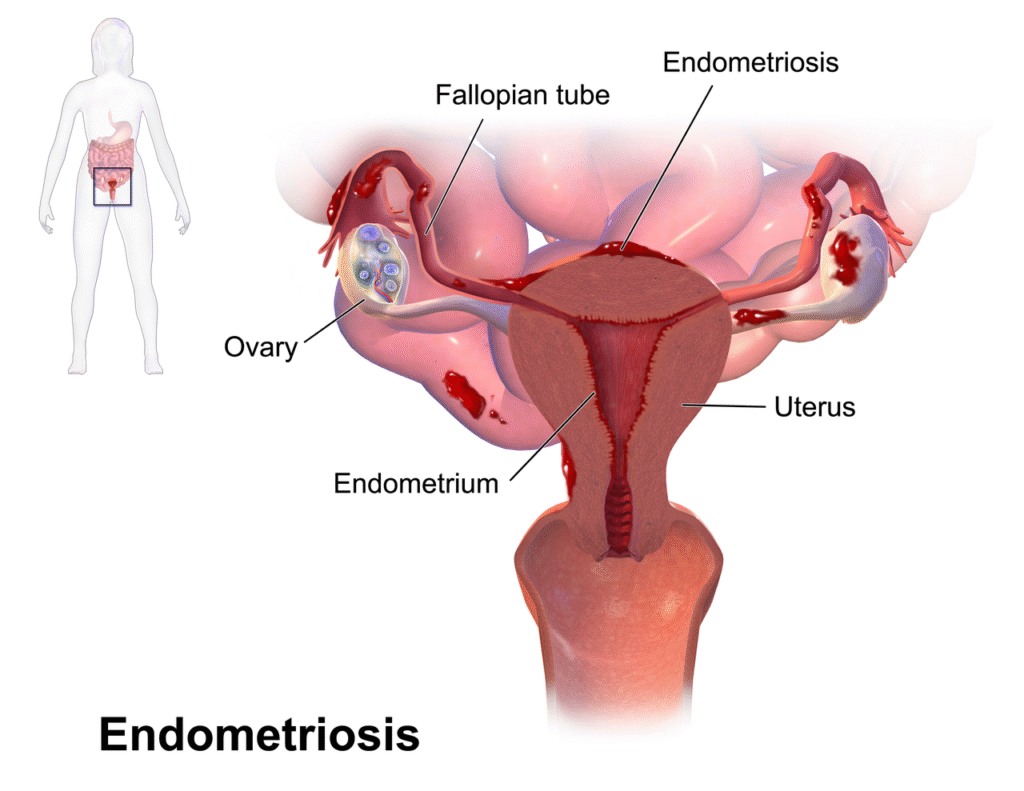 Endometriosis: Causes, Symptoms, Diagnosis, and Treatment