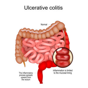 Ulcerative Colitis: Causes, Symptoms, Diagnosis, and Treatment