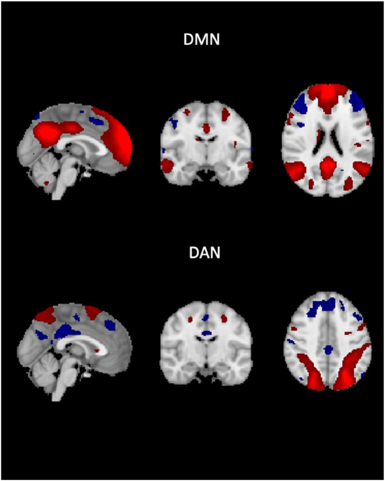 Can Your Brain’s 'Focus Mode' Tell You If You Have Alzheimer’s? New ...