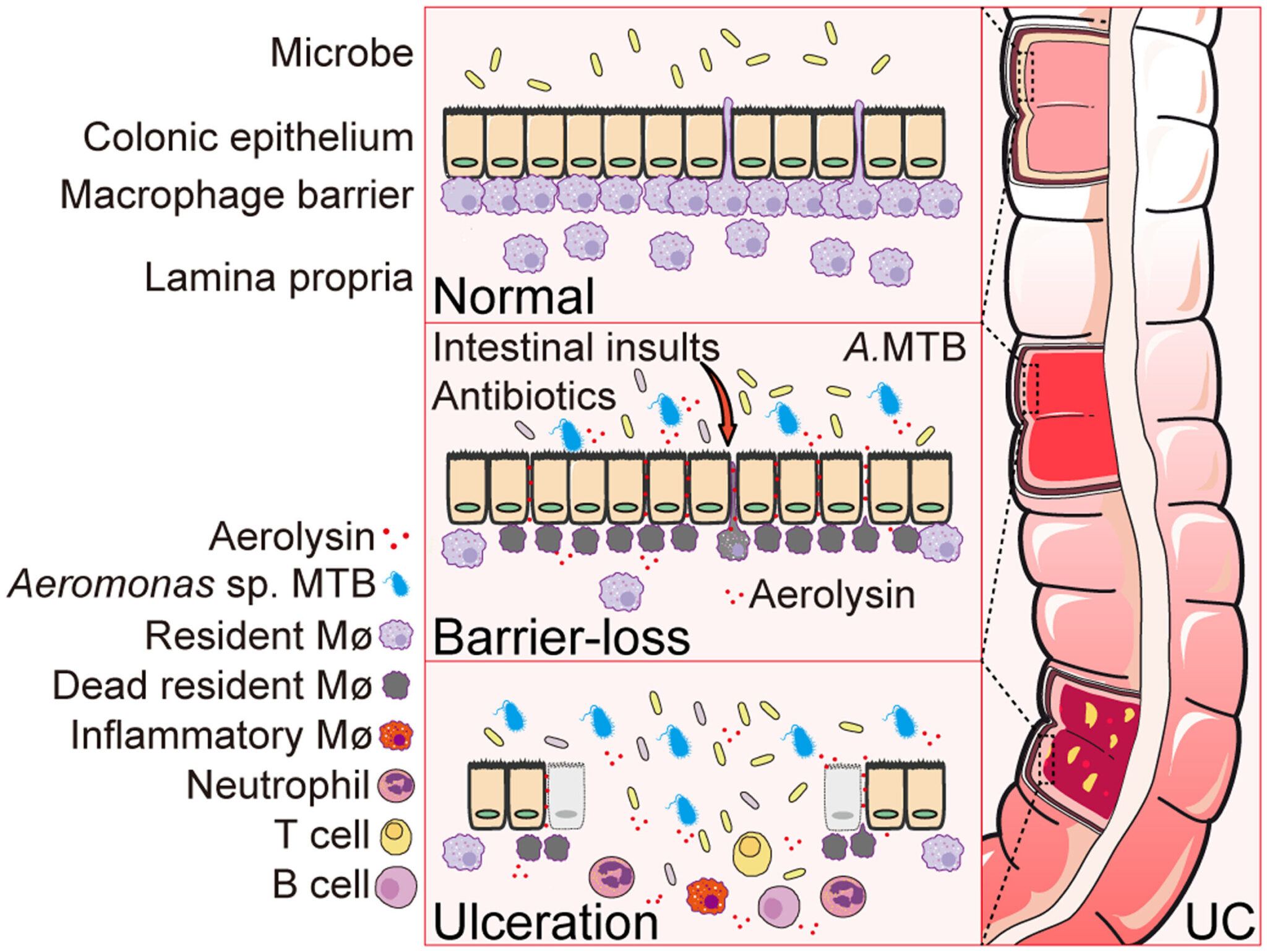 This Bacterial Toxin Could Be the Hidden Cause of Ulcerative Colitis