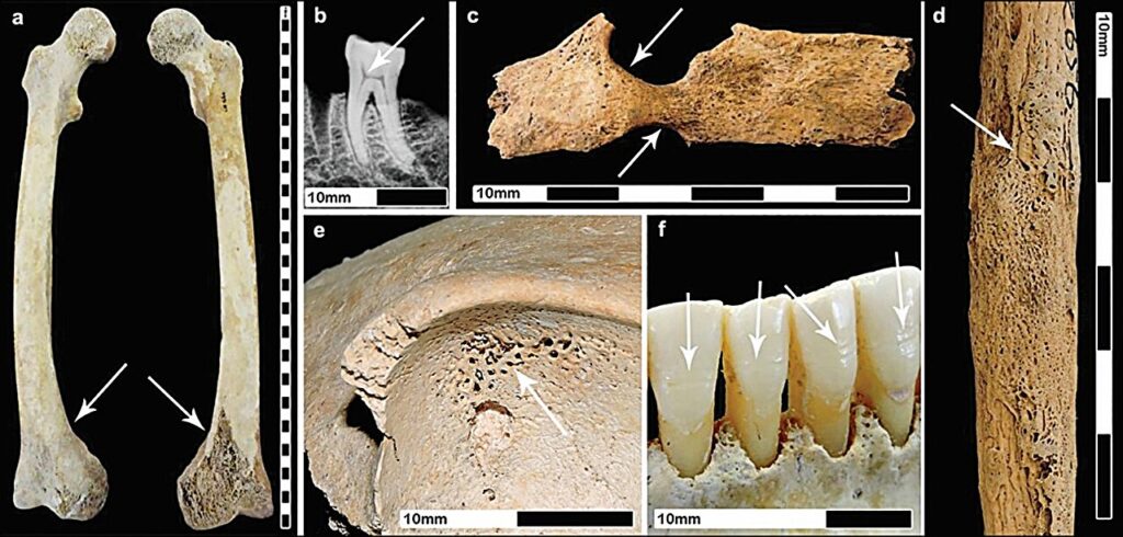 Mother and Child Bones Tell a Dark Story of Roman Urban Life